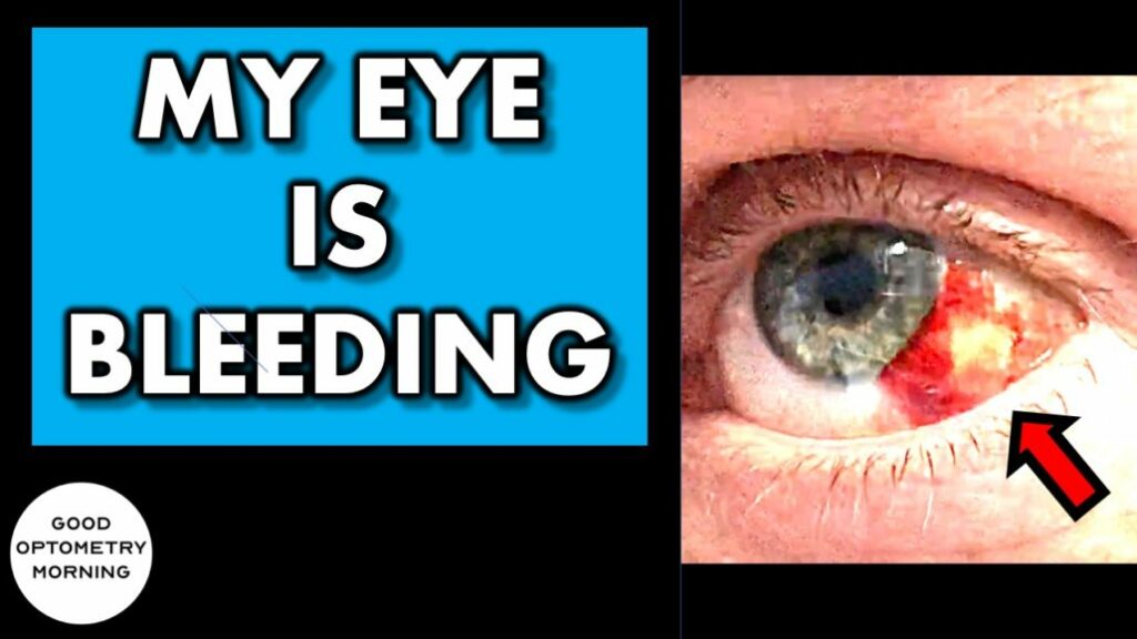Your eye is bleeding: What is it and how to treat a subconjunctival ...